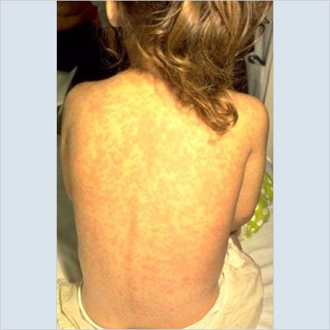 Measles for Medical Professionals | Shasta County CA